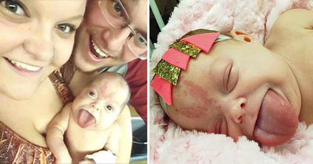 Bebis född med gigantisk tunga ler för första gången efter en lyckad ...